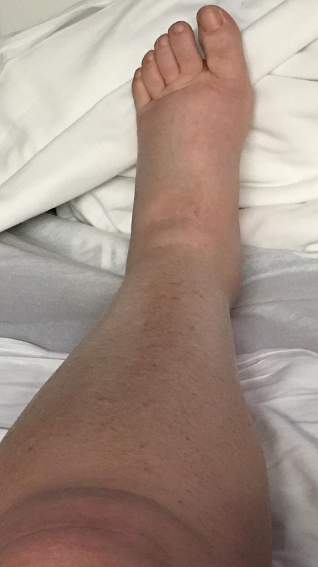 EDTA Induced Kidney Failure Resolved With Thiamine - Hormones Matter