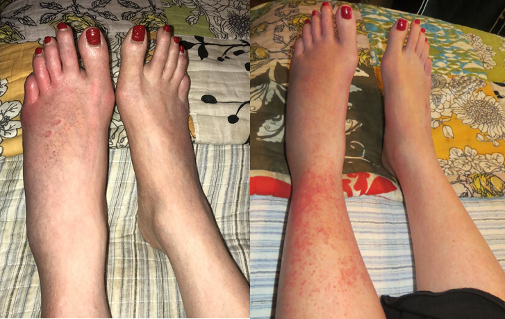 Progressive Deterioration of Health With Severe Nutrient Deficiency ...
